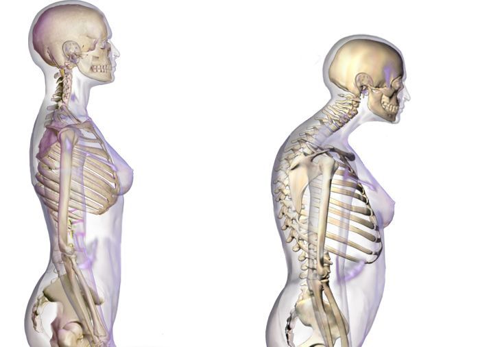 Homeopathy For Osteoporosis | Homeopathy Plus