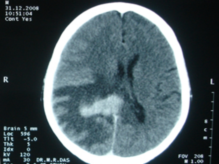 Homeopathy For Hernias | Homeopathy Plus